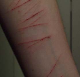 Cuts On Arms With Blade