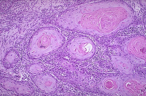 Pathology Cervix Squamous Cell Carcinoma