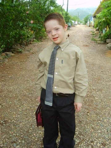 BIENVENIDOS A LAS ENFERMEDADES CEREBRALES-sindrome de down-trisomia 21 ...