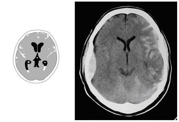 Subarachnoid Hemorrhage, Traumatic; Traumatic Subarachnoid Hemorrhage