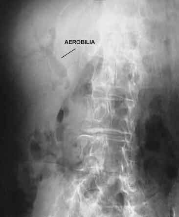 Radiografia simples do abdômen evidenciando sobre a loja hepática ...