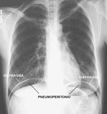 Pneumoperitonio