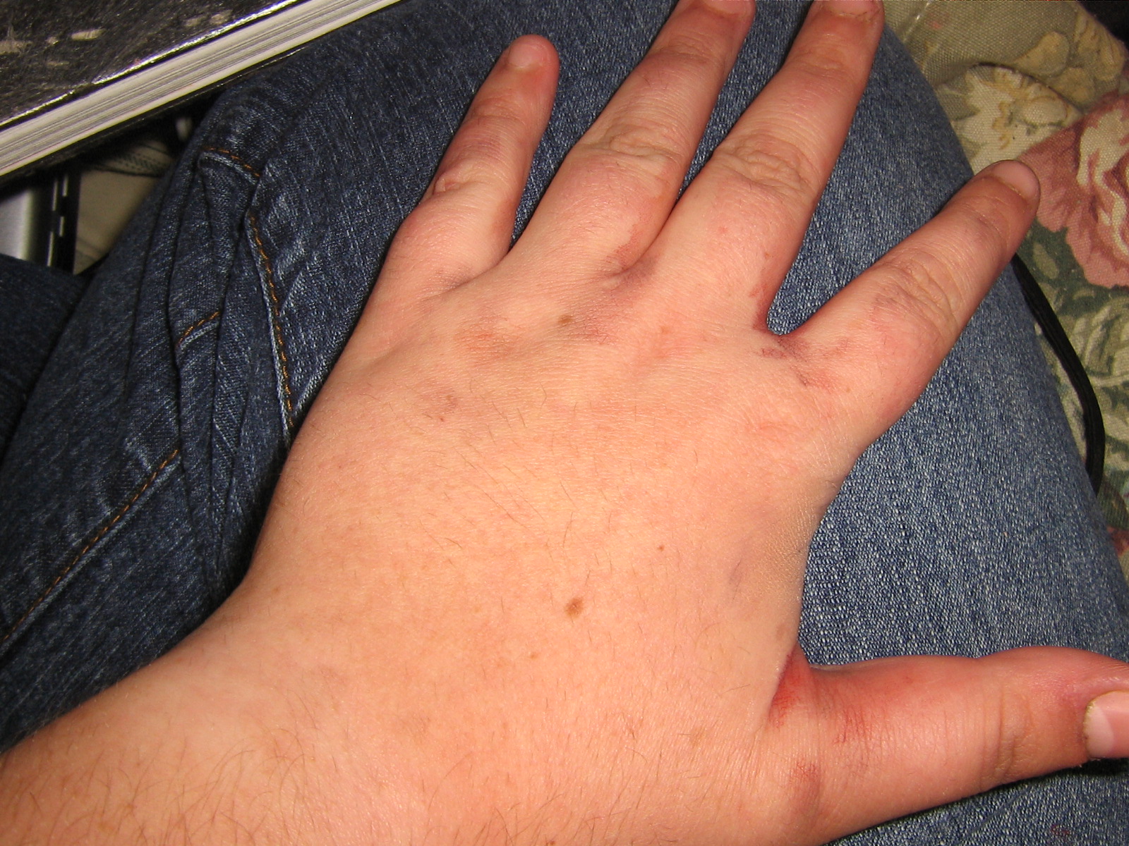 Chemical Burns
