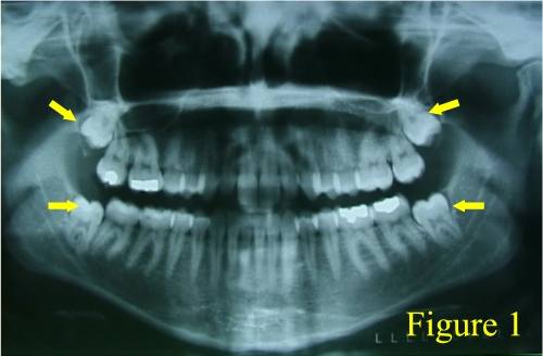 Wisdom Teeth Roots In Sinus