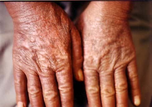 Pellagra Face Classical Skin Lesions In Pellagra Involving Face, Neck,