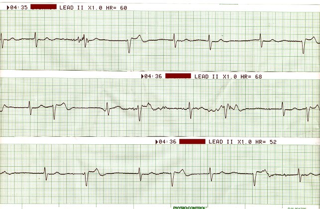 EKG 98 - Bradycardia with Ventricular escape beats