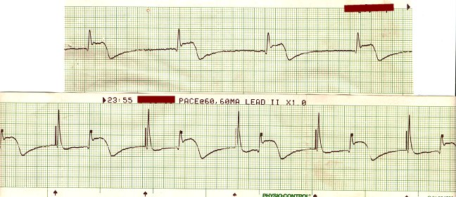 EKG 97 Profound Bradycardia/External Pacemaker