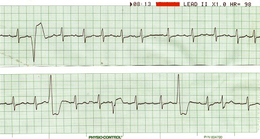 EKG 109 - Sinus Rhythm with PVCs