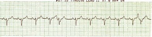 EKG 20 - Sinus Rhythm with PACs