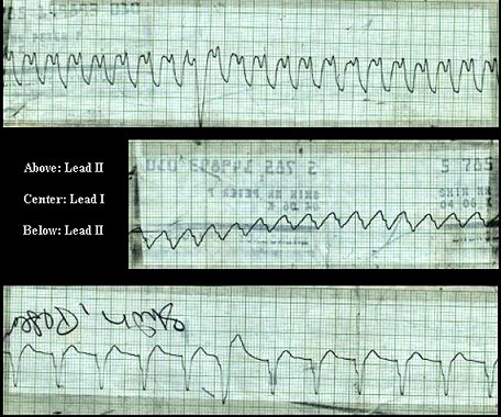 EKG 28 - V Tach CPA