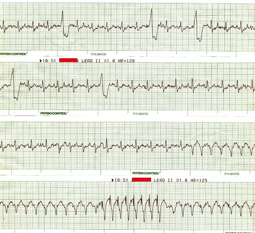 EKG 61 - PVCs-SVT vs V Tach