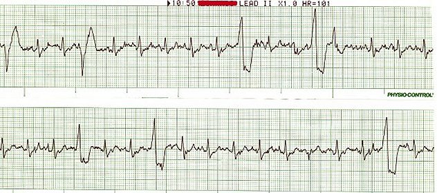 EKG 89 - Sinus tachycardia with multiformed PVCs
