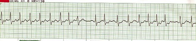 EKG 90 - Sinus Tachycardia with PACs