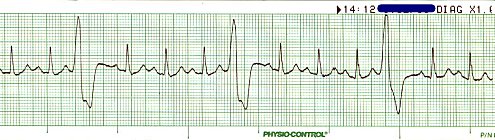Ventricular Quadrigeminy