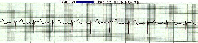 EKG 79 - Sinus Rhythm with 1st degree AV Block