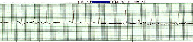 EKG 84 - Sinus Bradycardia with PVCs