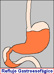 Tratamientos del Reflujo Gastroesof gico