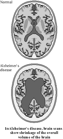 Alzheimer’s Disease
