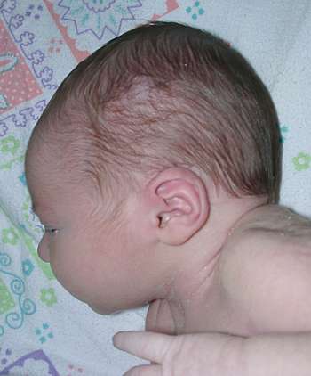 Webbed Neck Newborn