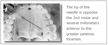 Greater Palatine nerve block