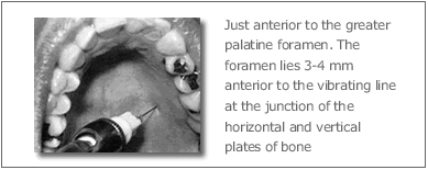 Greater Palatine nerve block