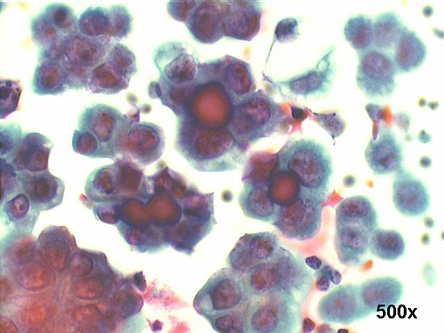 Psammoma Bodies Cytology