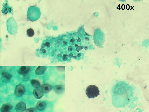 J. C. Prolla - Cytopatology BAL: pneumocystosis