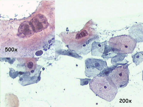 J. C. Prolla - Cytopathology uterine cervix: ASC-US