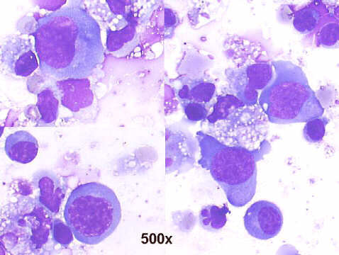 J. C. Prolla - Cytopathology Spinal fluid: abundant Türk's cells