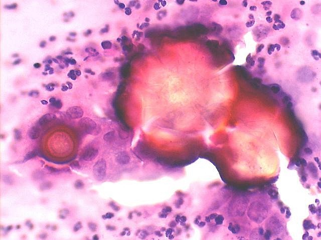 Psammoma Bodies Cytology