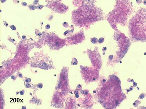 J. C. Prolla - Cytopathology case 09A 2004