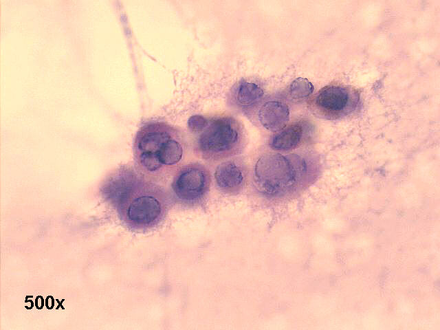 Tzanck Smear