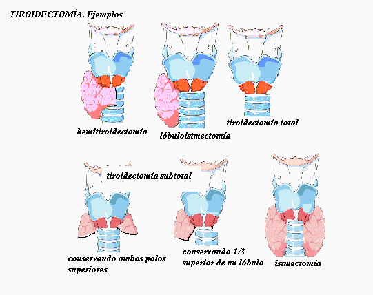 Tiroidectomia