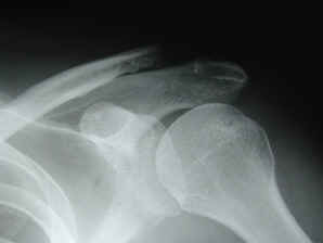 Acromioclavicular Joint Arthritis and Arthroscopic Decompression of AC ...