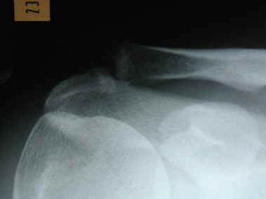 Acromioclavicular Joint Arthritis and Arthroscopic Decompression of AC ...