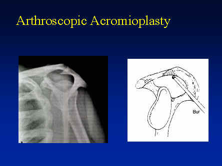 Subacromial Impingement and Arthroscopic Subacromial Decompression
