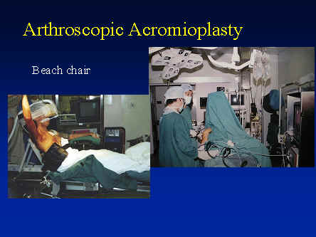 Subacromial Impingement and Arthroscopic Subacromial Decompression