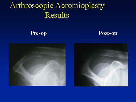 Subacromial Impingement and Arthroscopic Subacromial Decompression