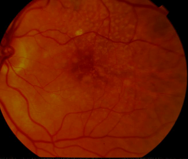Macular Degeneration - Kota Eye Hospital