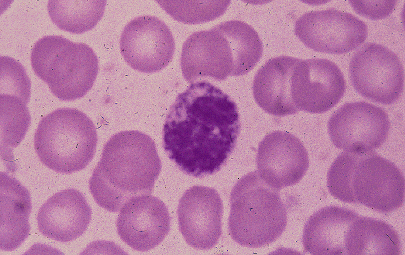 Figuur 4 :Lymfocyten en een lymfoblast (een onrijpe lymfocyt)
