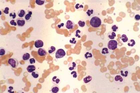 Figuur 8 :Chronische leukemie