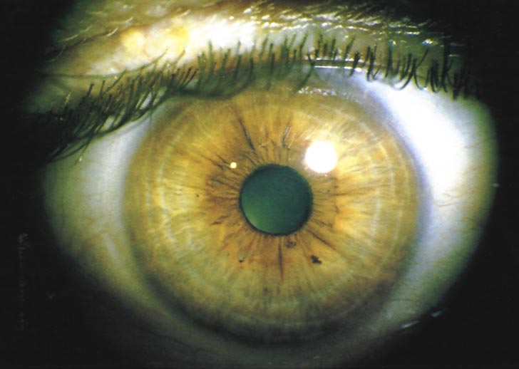 Iridologia e Homeopatia