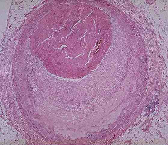 Pathology - Coronary artery: organized thrombus