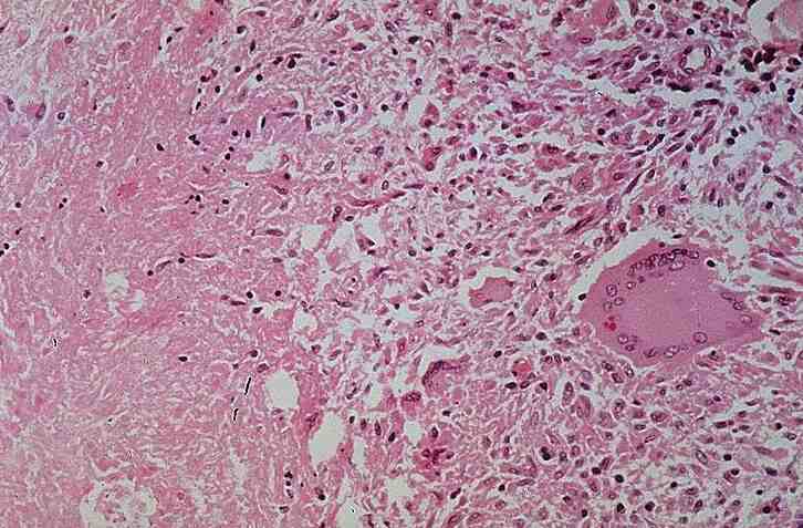 Tuberculosis Histology Histopathology Tuberculosis Light Micrograph