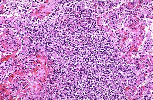 biopsy accidentally misinterpreted? : r/pathology