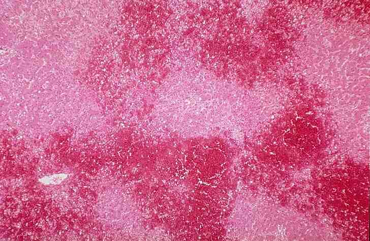 Nutmeg Liver Histology Vascular Disorders Of The Liver | Abdominal Key