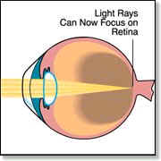 What is Myopia