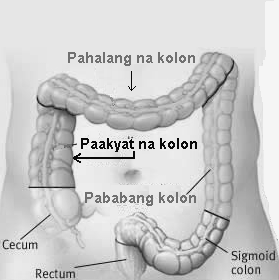 Colon Cancer