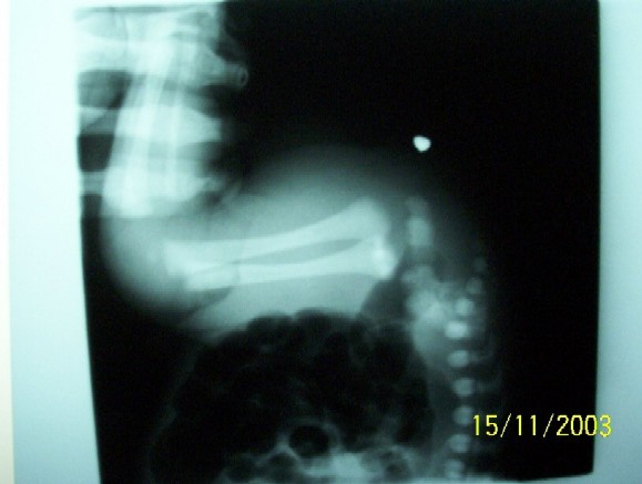 Multiples calcificaciones por cistecercosis