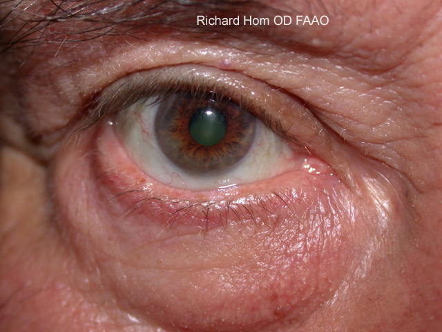 Grand Rounds Case 87 - Response - Richard Hom OD FAAO